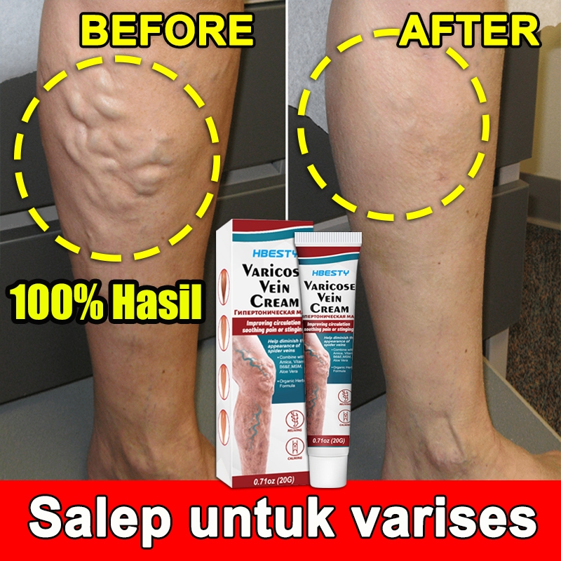 Jual 【100% Asli】Obat Varises Varicose Veins Cream Penghilang Varises ...
