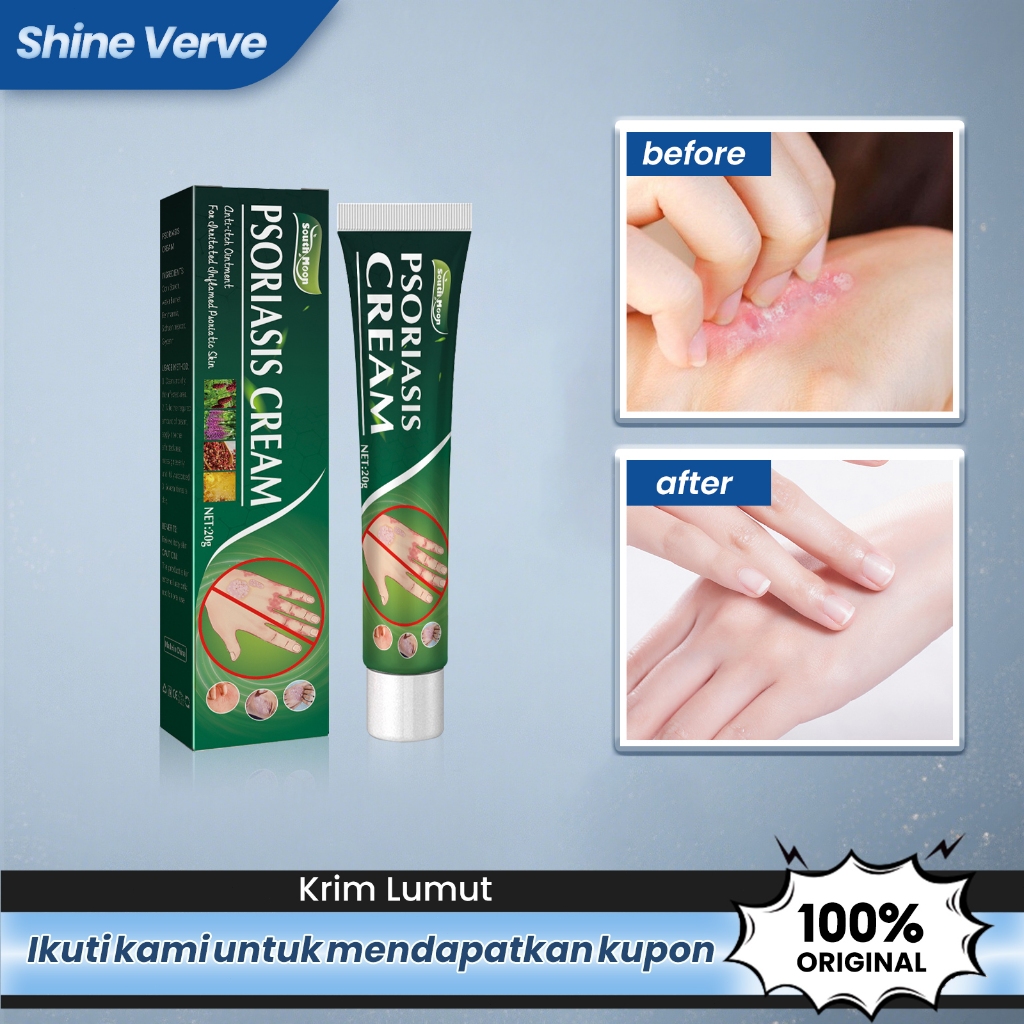 Jual South Moon Psoriasis Cream 20g Obat Kurap Salep Gatal Eksim Paling ...