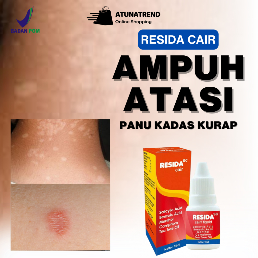 Jual Resida Obat Panu Kadas Kurap Untuk Kulit Gatal Eksim Paling Ampuh ...