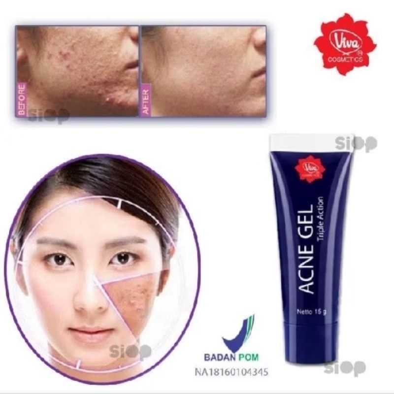 Jual Viva Acne Gel Triple Action 15g | Shopee Indonesia