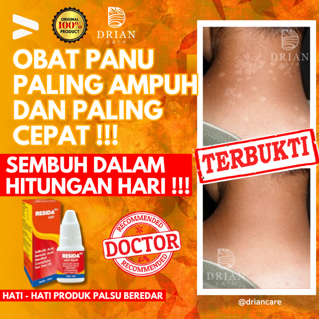 Jual Obat Panu Paling Ampuh 100% Obat Gatel Gatal Kadas Kurap Jamur ...