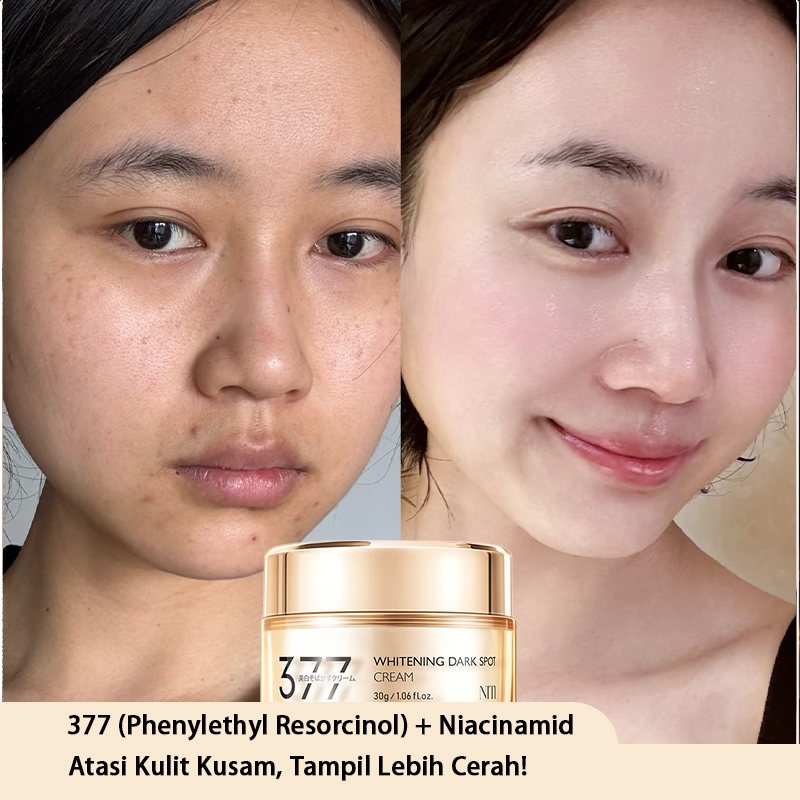 Jual 377 cream flek hitam membandel dark spot treatment 30g Memperbaiki ...