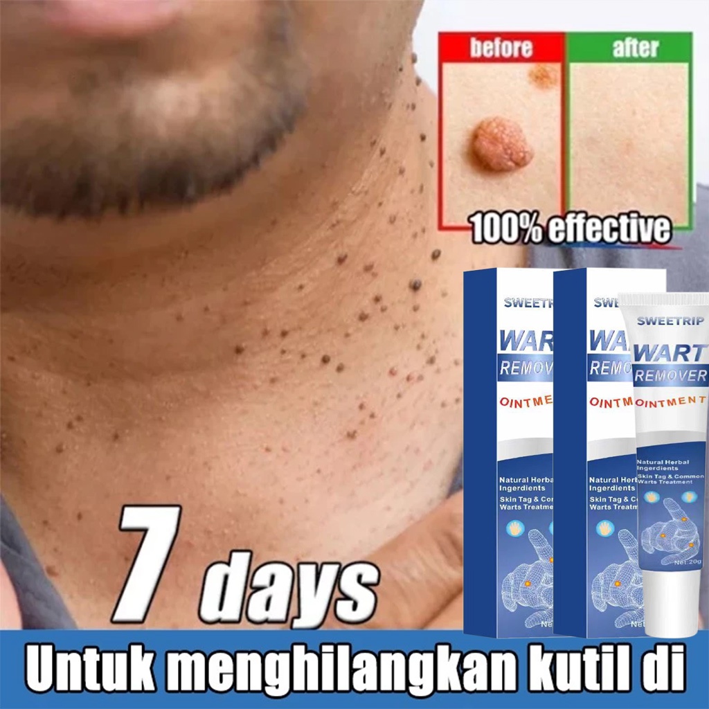 Jual Krim Penghilang Tahi Lalat Dan Kutil 20g Krim Penghilang Kutil ...