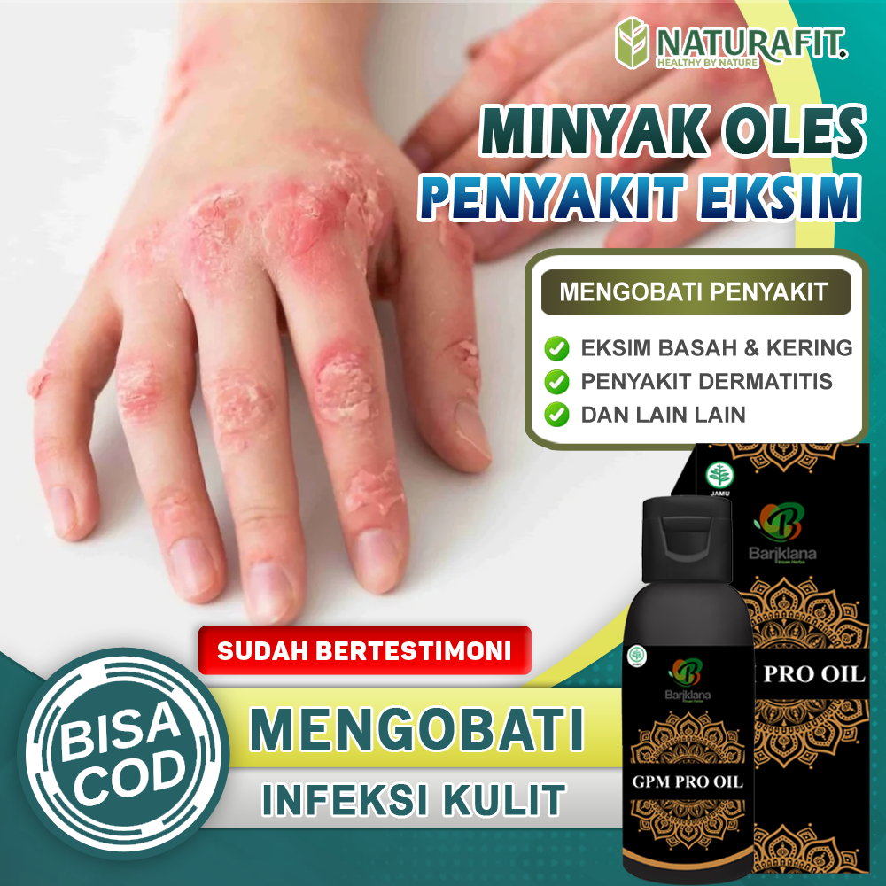 Jual Obat Eksim Basah Dan Kering Paling Ampuh Dermatitis Jamur ...