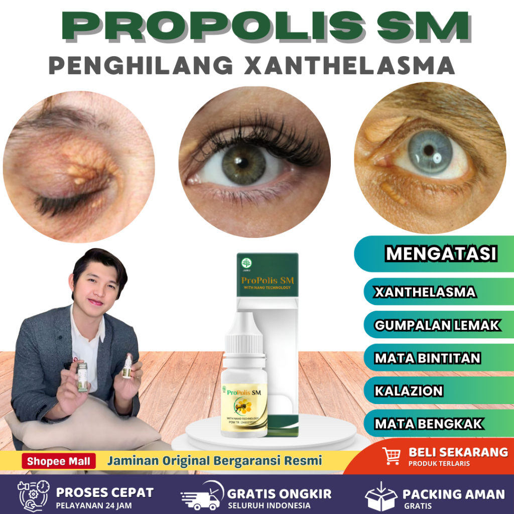 Jual Obat Gumpalan Lemak Di kelopak Mata Xanthelasma Milia Dekat Mata ...