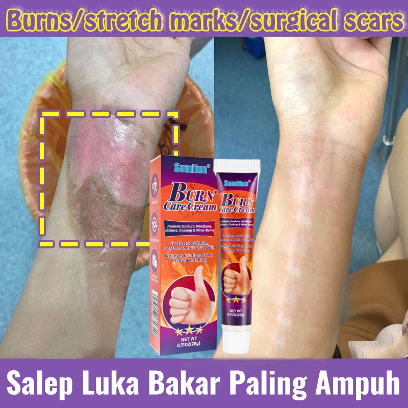 Jual Salep luka bakar Penghilang luka bakar Menghilangkan Bekas Luka ...