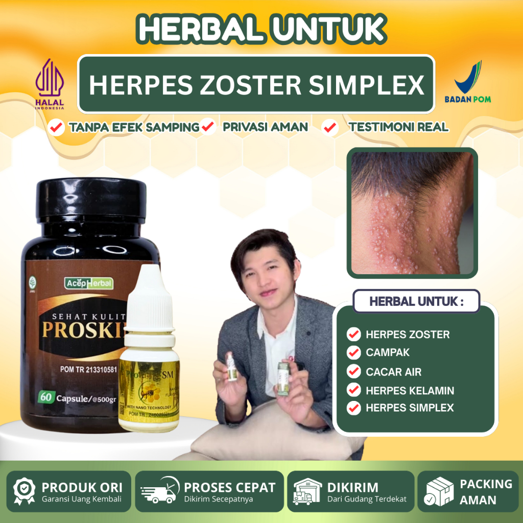 Jual Penghilang herpes herves zoster Gatal Berair Cacar air Herpes ...