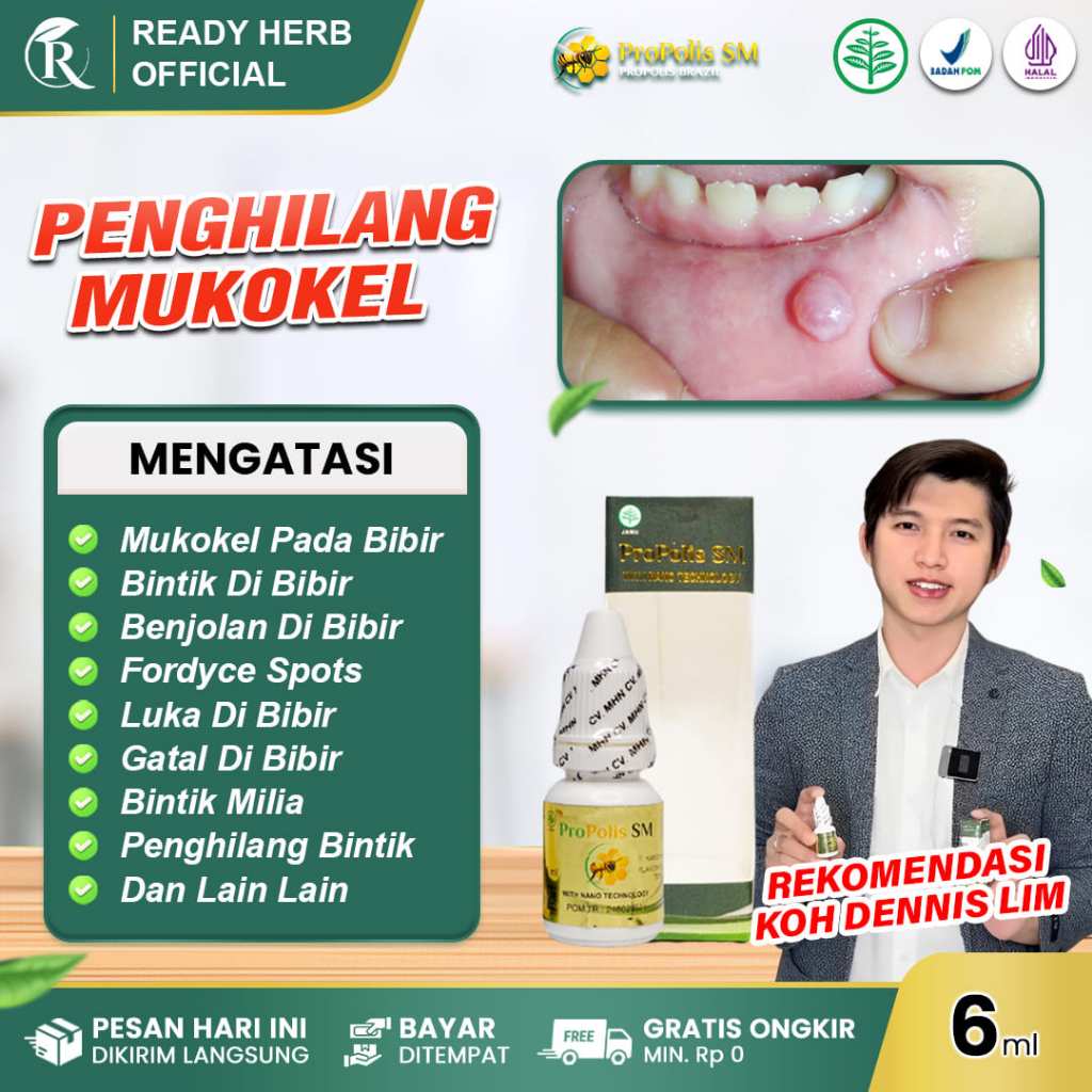 Jual PROPOLIS SM Obat Fordyce Spots Bibir Mukokel Penghilang Bintik Di ...