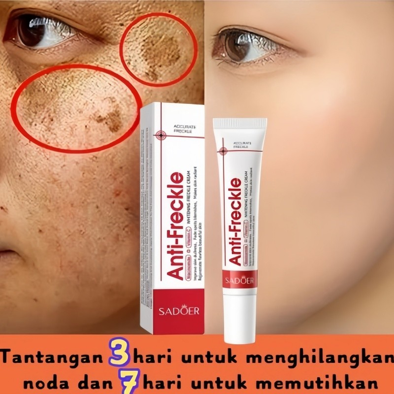 Jual Whitening blemish Freckle Cream Remove Dark Spots Anti Freckle Cream Niacinamide Fade ...