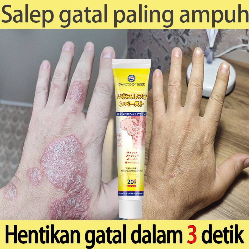 Jual krim eksim gatal 20g itchy skin cream Treat eczema tinea pedis ...
