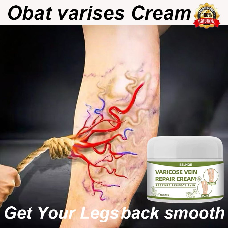 Jual Obat varises Cream varises paling ampuh original Varises kaki ...