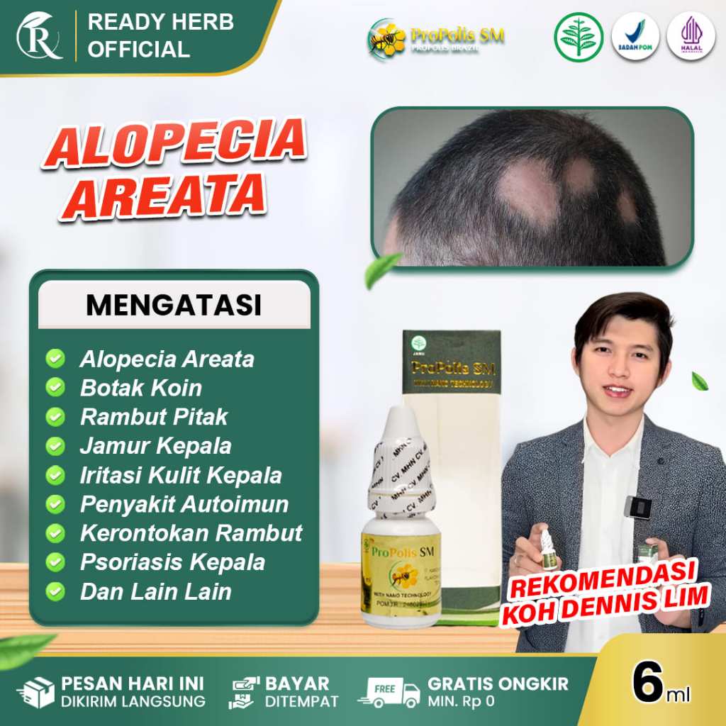 Jual Obat Alopecia Areata Botak Koin Tinea Capitis Rambut Pitak ...