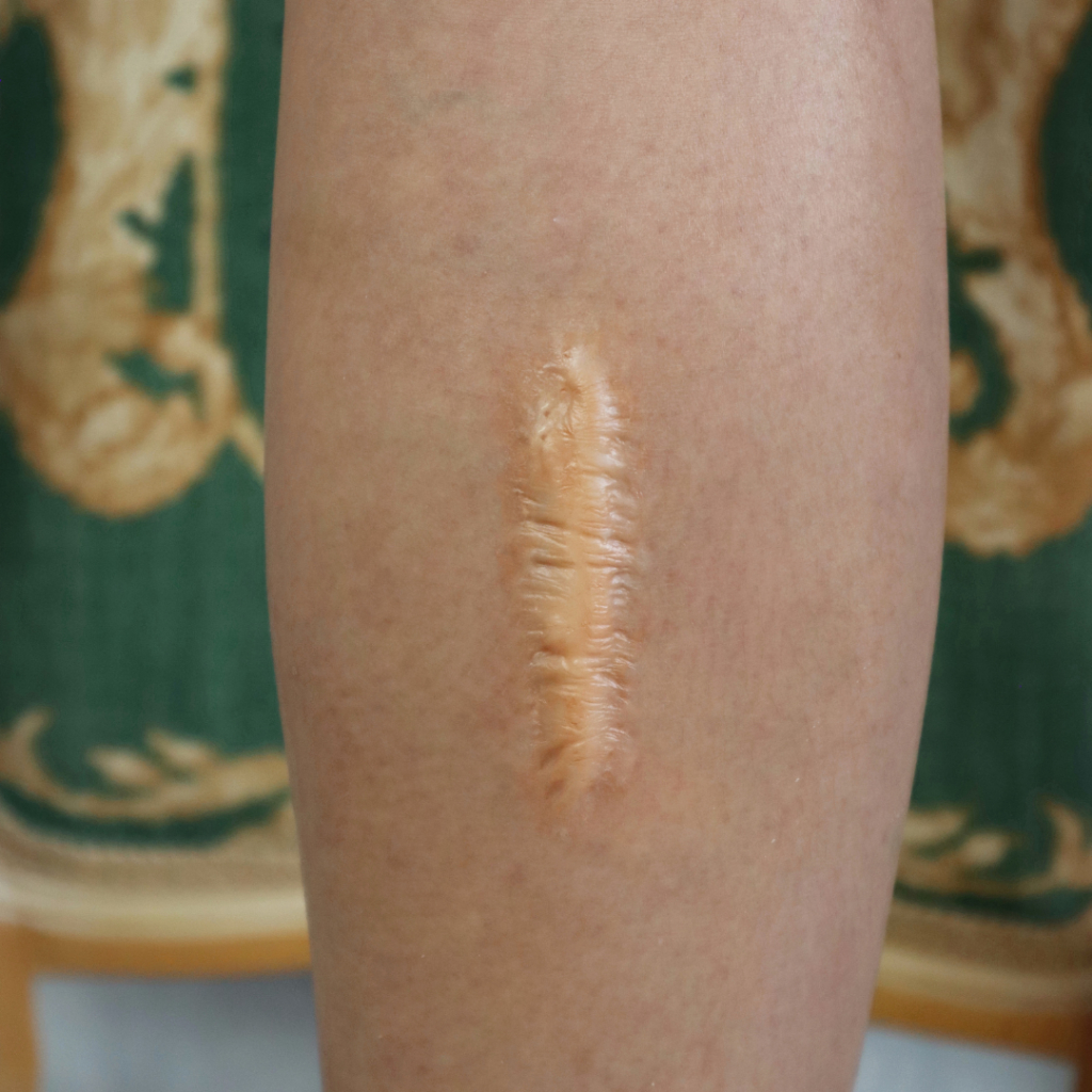 Jual [PRODUK LOKAL] REALISTIC KELOID SCAR | BEKAS LUKA PALSU | SFX ...