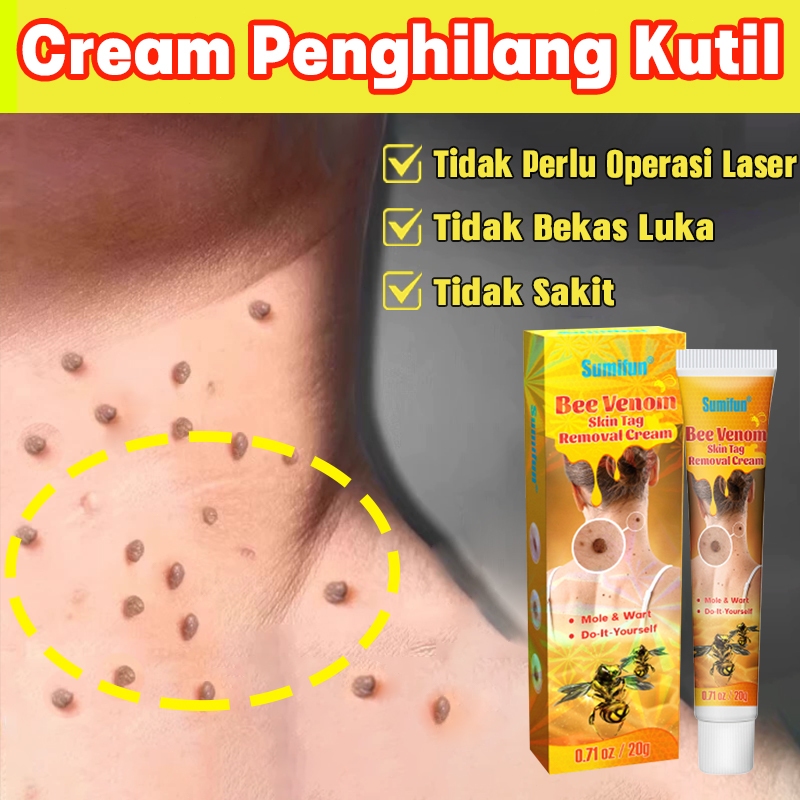Jual [Obat Kutil Ampuh]Krim Penghilang Kutil Alami,krim penghilang ...
