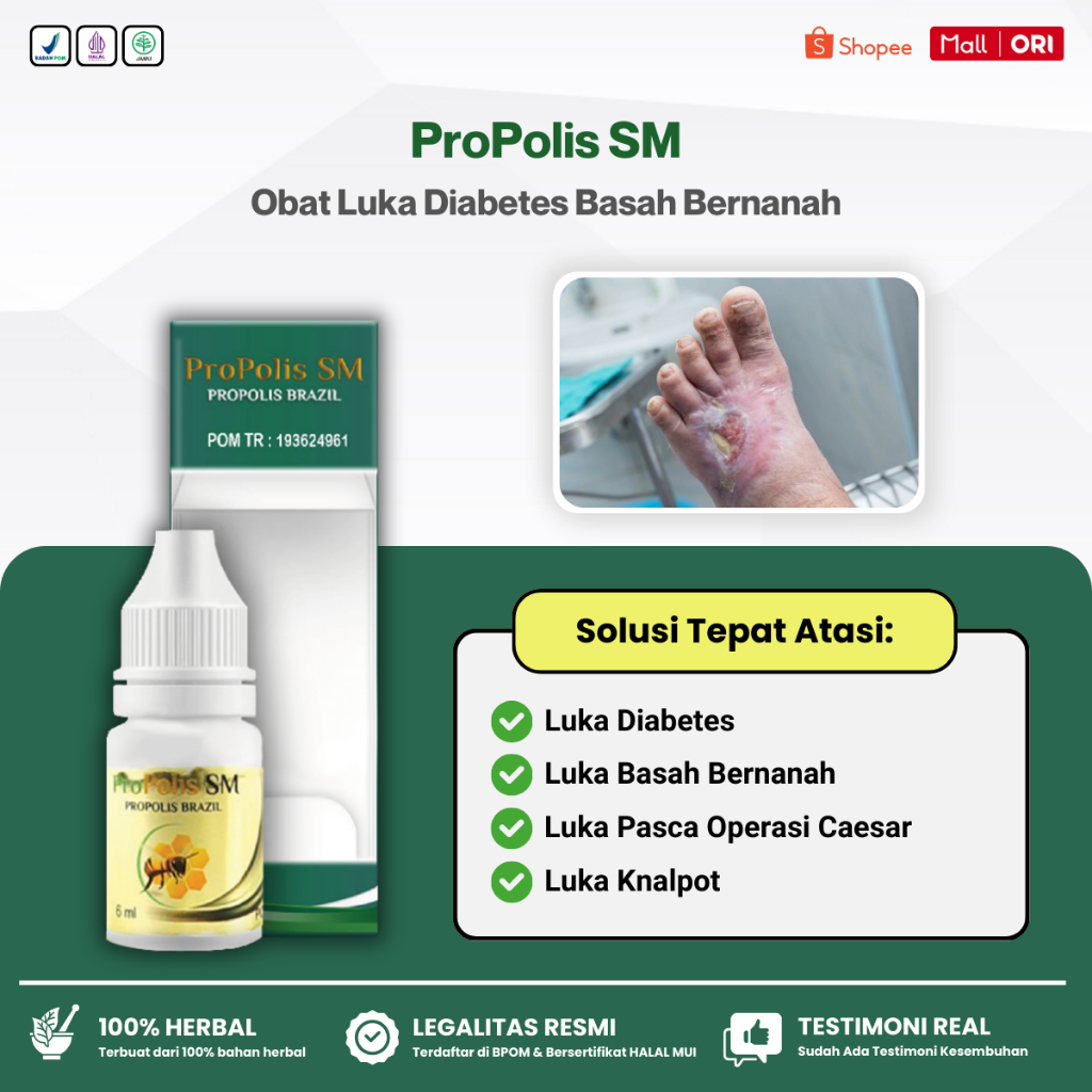 Jual Propolis SM - Obat Luka Diabetes Bernanah Basah, Obat Pengering ...