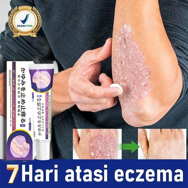 Jual Psoriasis ointment Obat oles infeksi kulit Obat gatal Salep ...