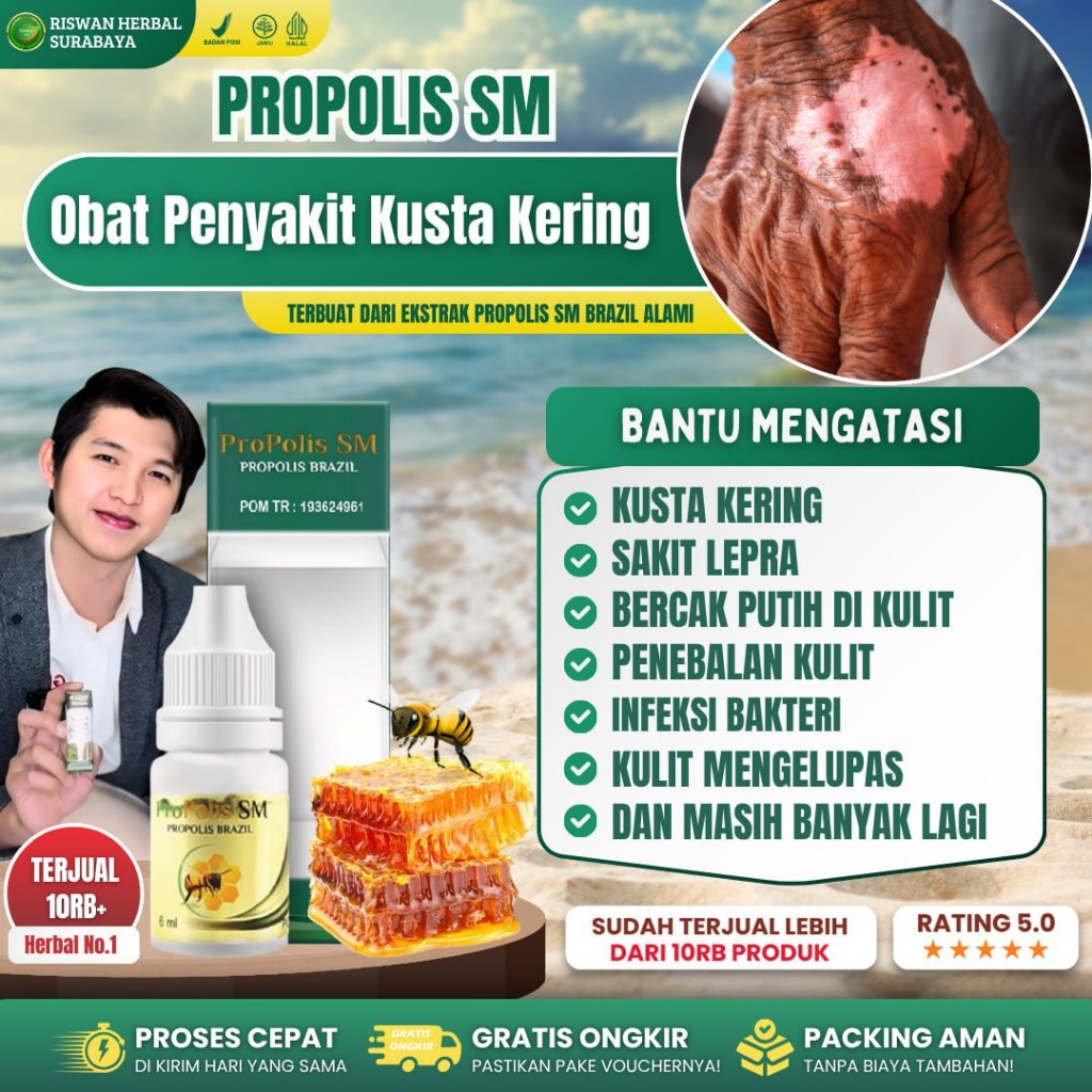 Jual Obat Penyakit Kusta Kering Dan Basah Gatal Kulit Ruam Di Tangan ...