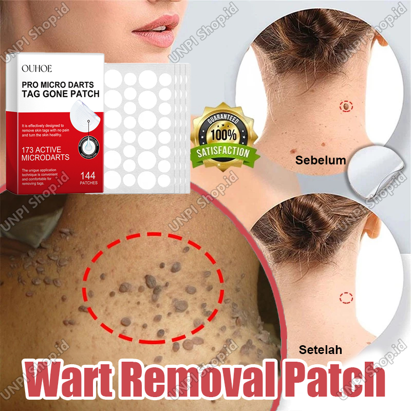 Jual Sticker Penghilang Kutil Dan Tahi Lalat Obat Kutil Di Wajah ...