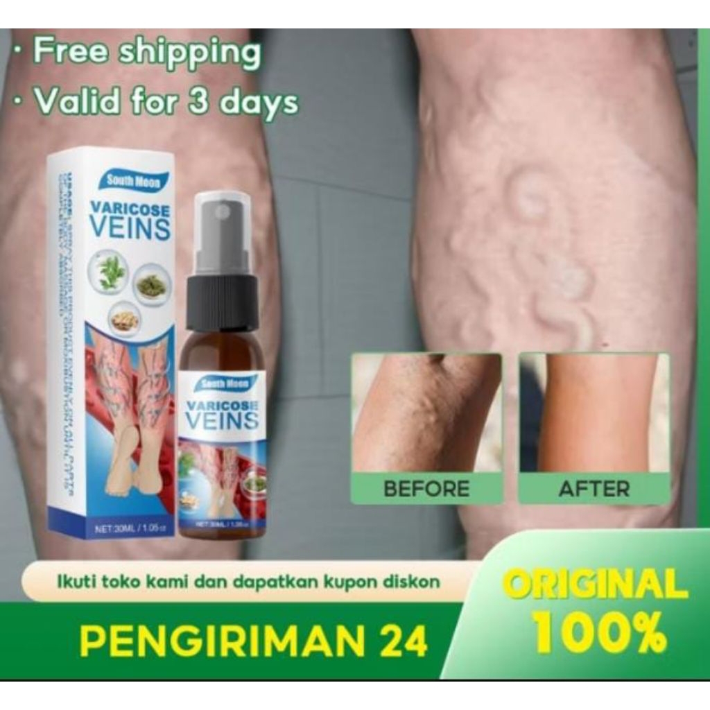 Jual Obat Varises Salep Cream Oles Varicose Veins Spray Original ...