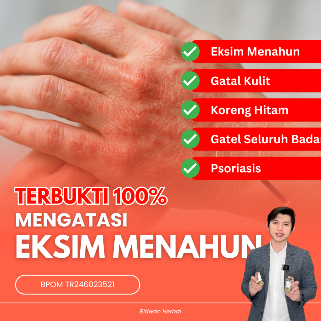 Jual Obat Eksim Menahun, Eksim Kering, Salep Eksim, Eksim basah, Gatal ...