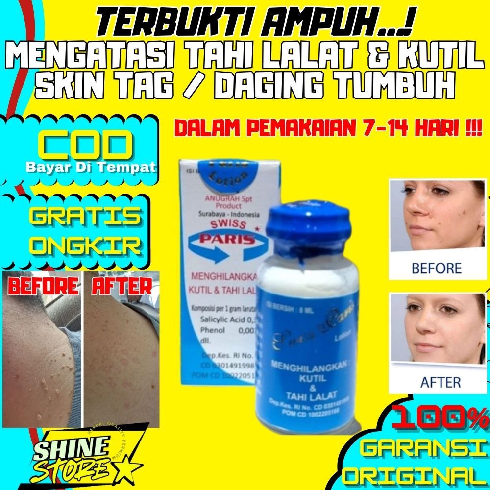 Jual Sumifun Wart Removal Skin Tag Eelhoe Wart Remover Obat Penghilang ...