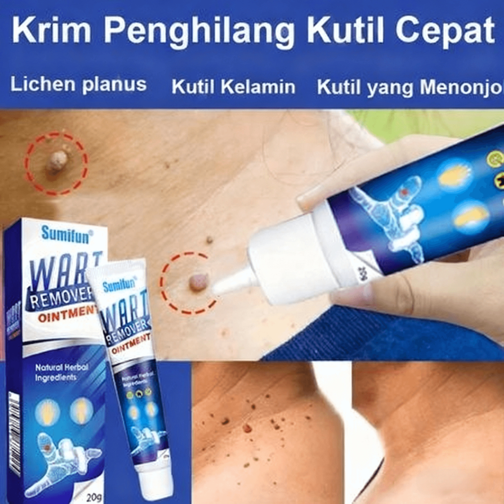 Jual Penghilang kutil dan tahi lalat | Salep kutil paling ampuh | Krim ...