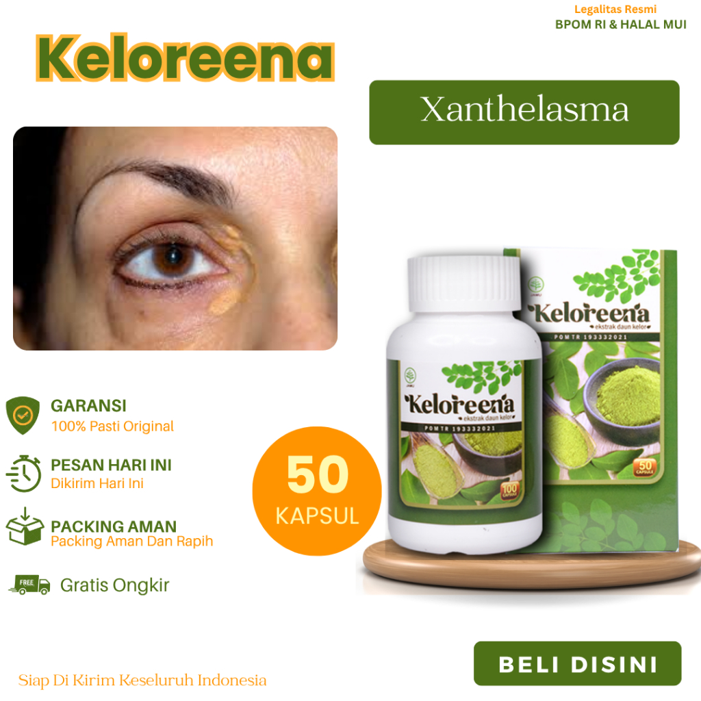 Jual Obat Xanthelasma, Gumpalan Daging di Kelopak Mata, Plak Mata ...