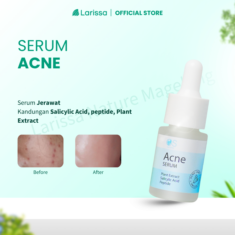 Jual Larissa Acne Serum - Serum Wajah Untuk Mengatasi Jerawat dan ...