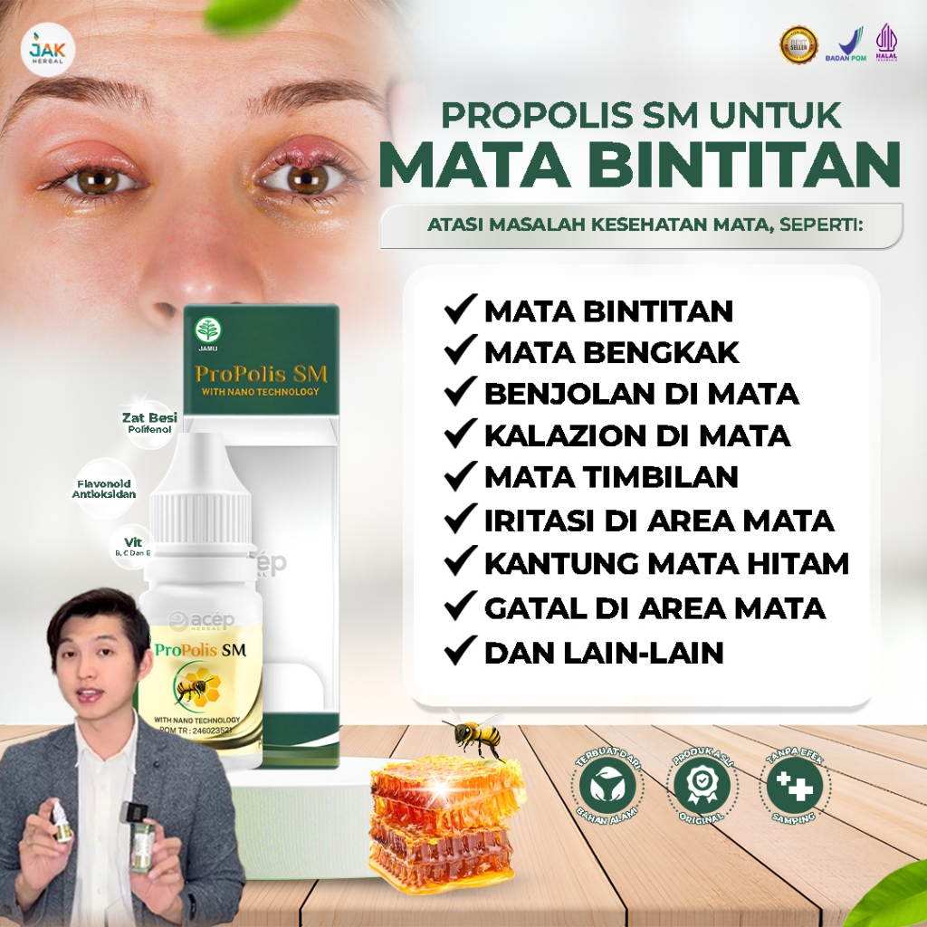 Jual Obat Mata Bintitan Benjolan Di Kelopak Mata Kalazion Timbilan Mata ...