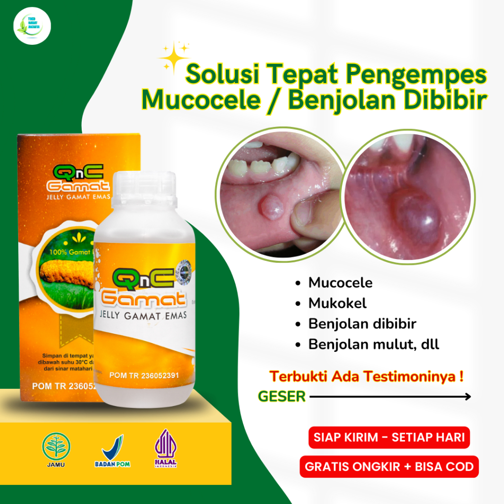 Jual Obat Salep Untuk Mucocele, Mukokel,Kista Di Mulut, Benjolan Di ...