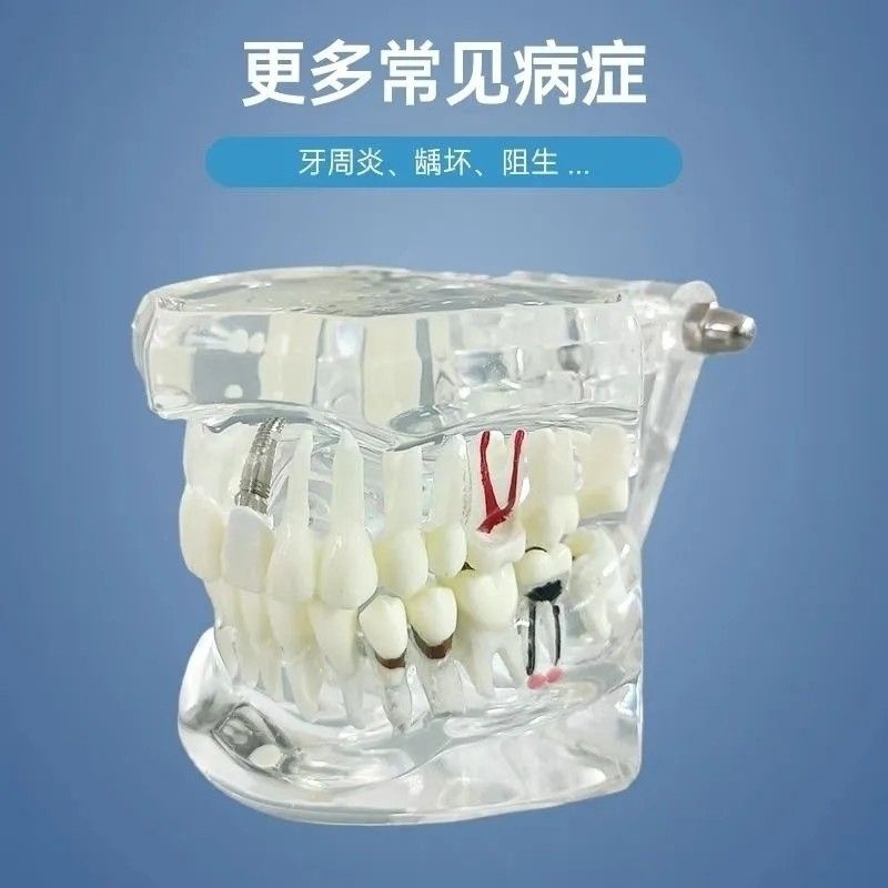 Jual model gigi model study gigi edukasi studi implant model gigi ...