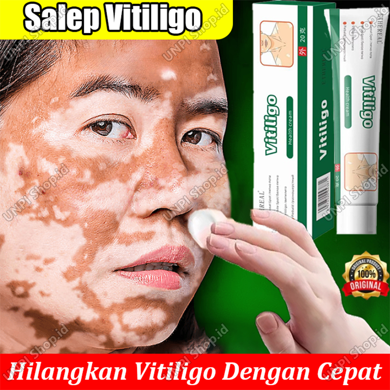 Jual Salep Vitiligo Paling Ampuh Obat Vitiligo Cream Original Salep ...