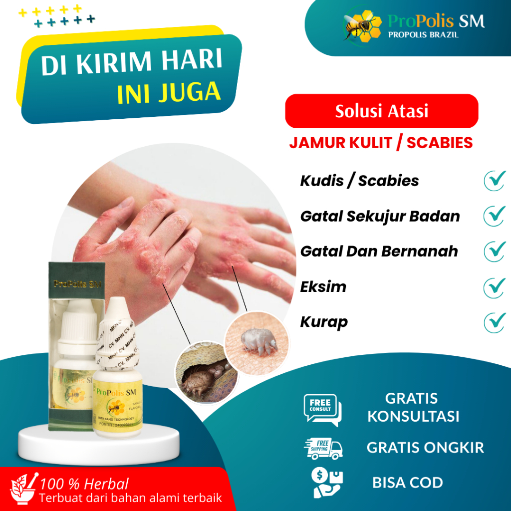 Jual Obat Scabies Jamur Kulit Eksim Kurap Gudik Herpes Gatal Seluruh ...