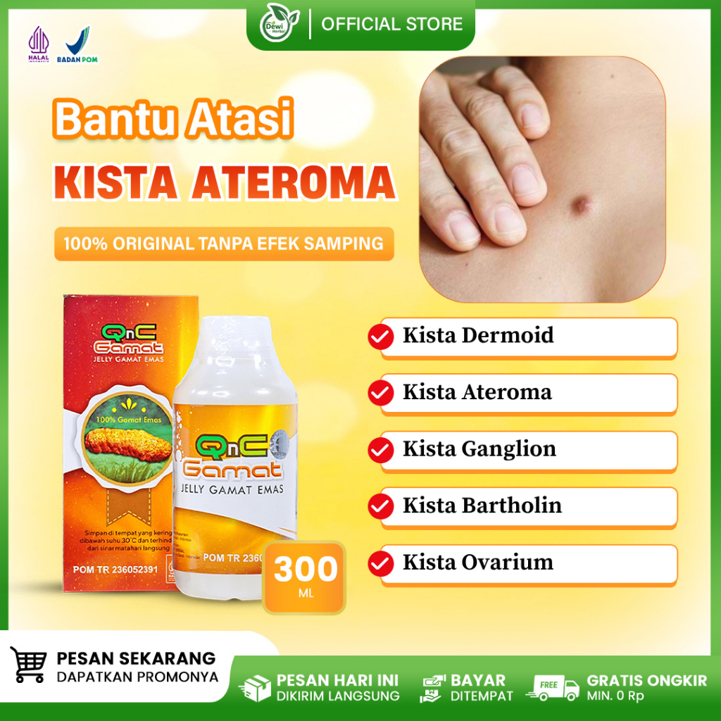 Jual Obat Kista Dermoid - Kista Ateroma - Kista Ganglion - Obat ...