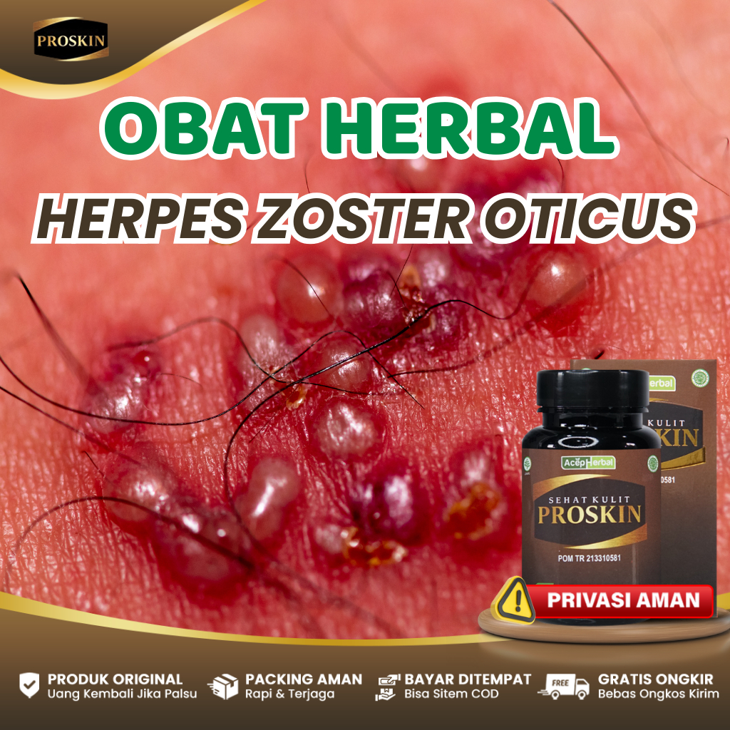 Jual Obat Herbal Mengatasi Herpes Zoster Oticus (Telinga/Ramsay Hunt ...