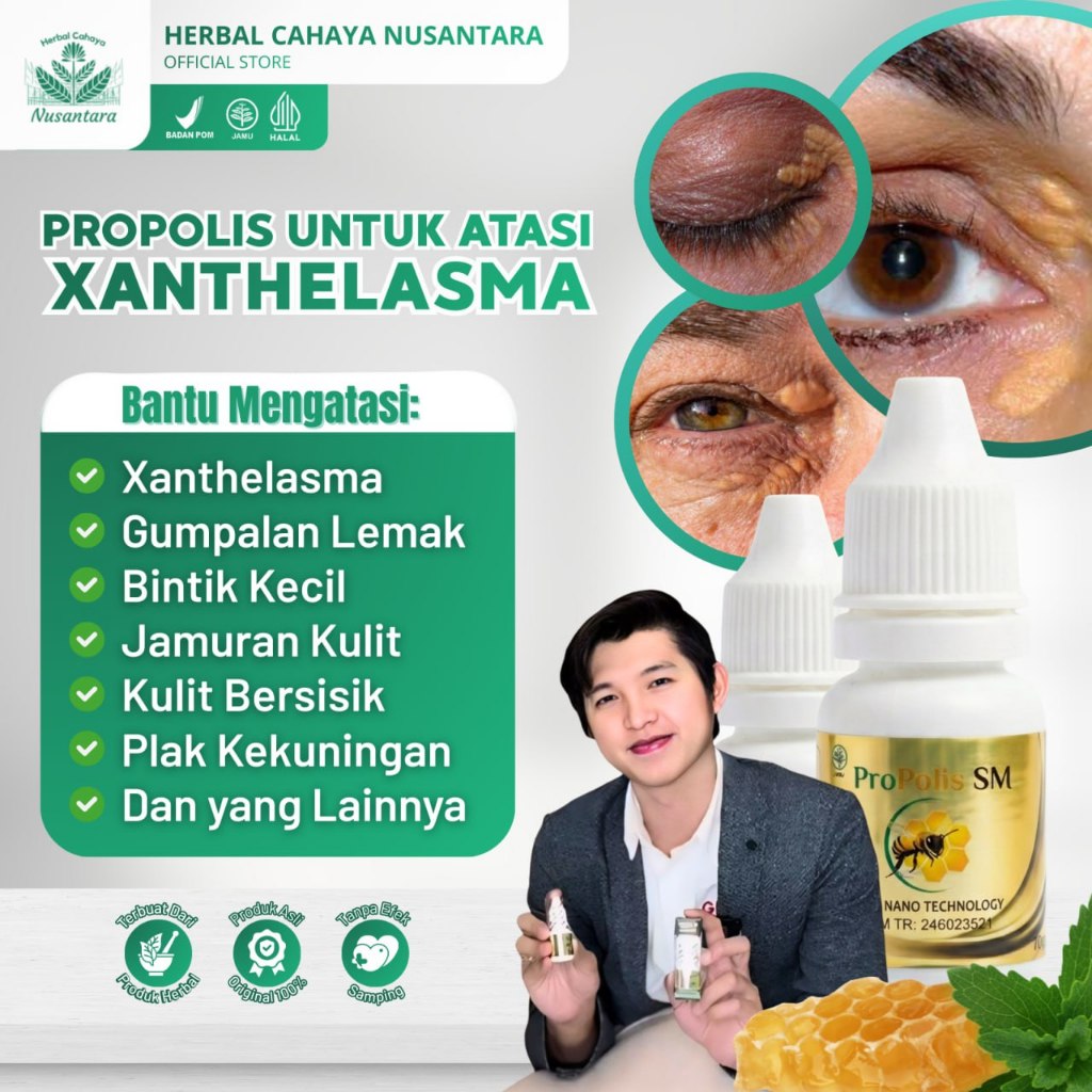 Jual Obat Xanthelasma Penghilang Gumpalan Lemak di Kelopak Mata ...