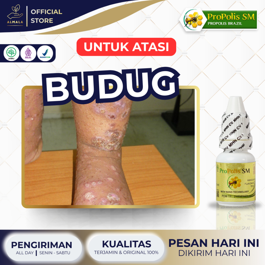 Jual Obat Budug, Budug Di Kaki, Gudik, Scabies, Gatal di Kaki, Bekas ...