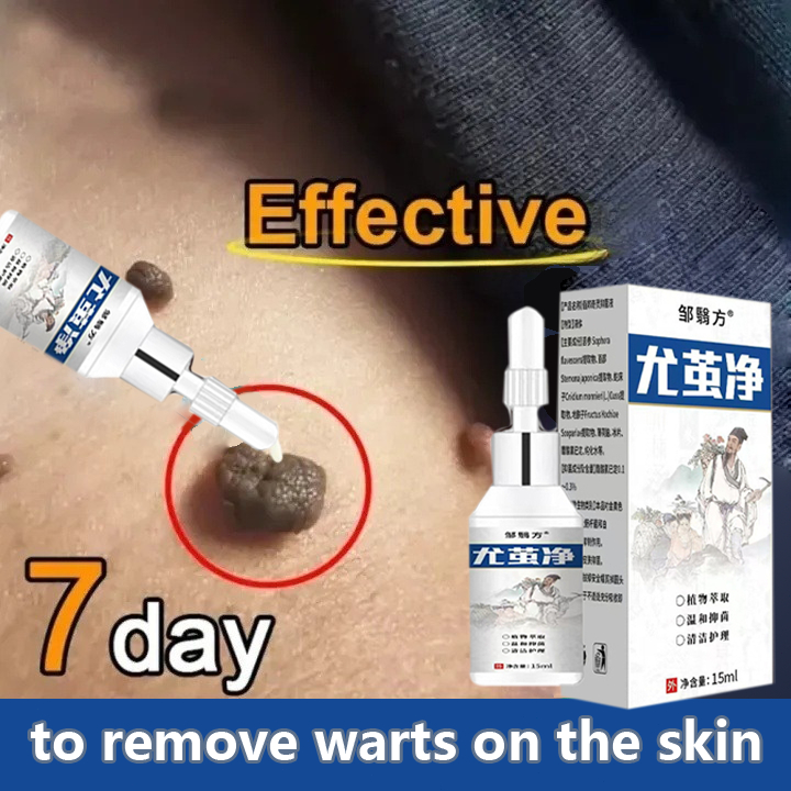 Jual 100% Asli Penghilang Tahi Lalat Penghilang Kutil Skin Tag Remover ...