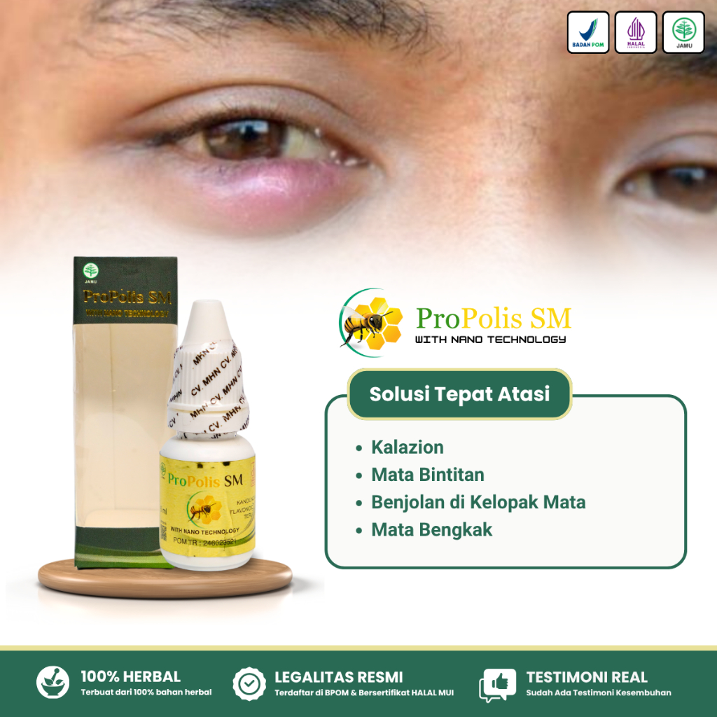 Jual Obat Kalazion Mata Bintitan Mata Bengkak Mata Hordeolum Benjolan ...
