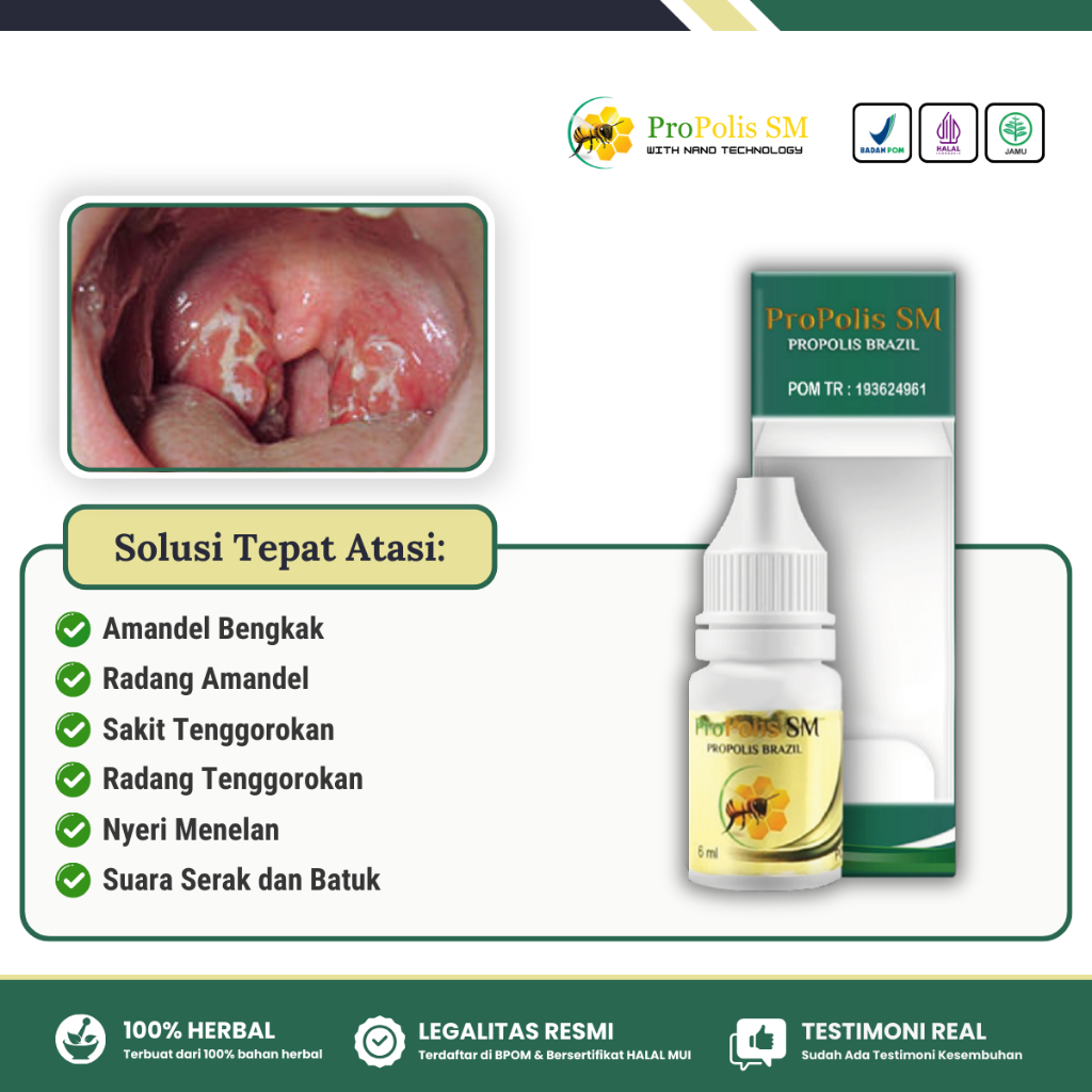 Jual Obat Amandel Anak Dan Dewasa, Pengempes Amandel Bengkak, Radang ...