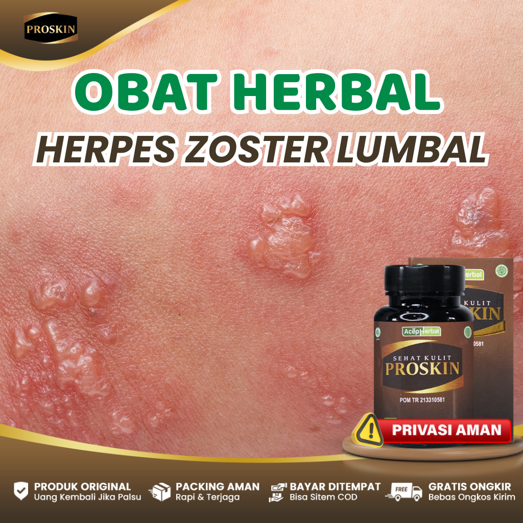 Jual Obat Herbal Mengatasi Herpes Zoster Lumbal (Pinggeng & Kaki ...