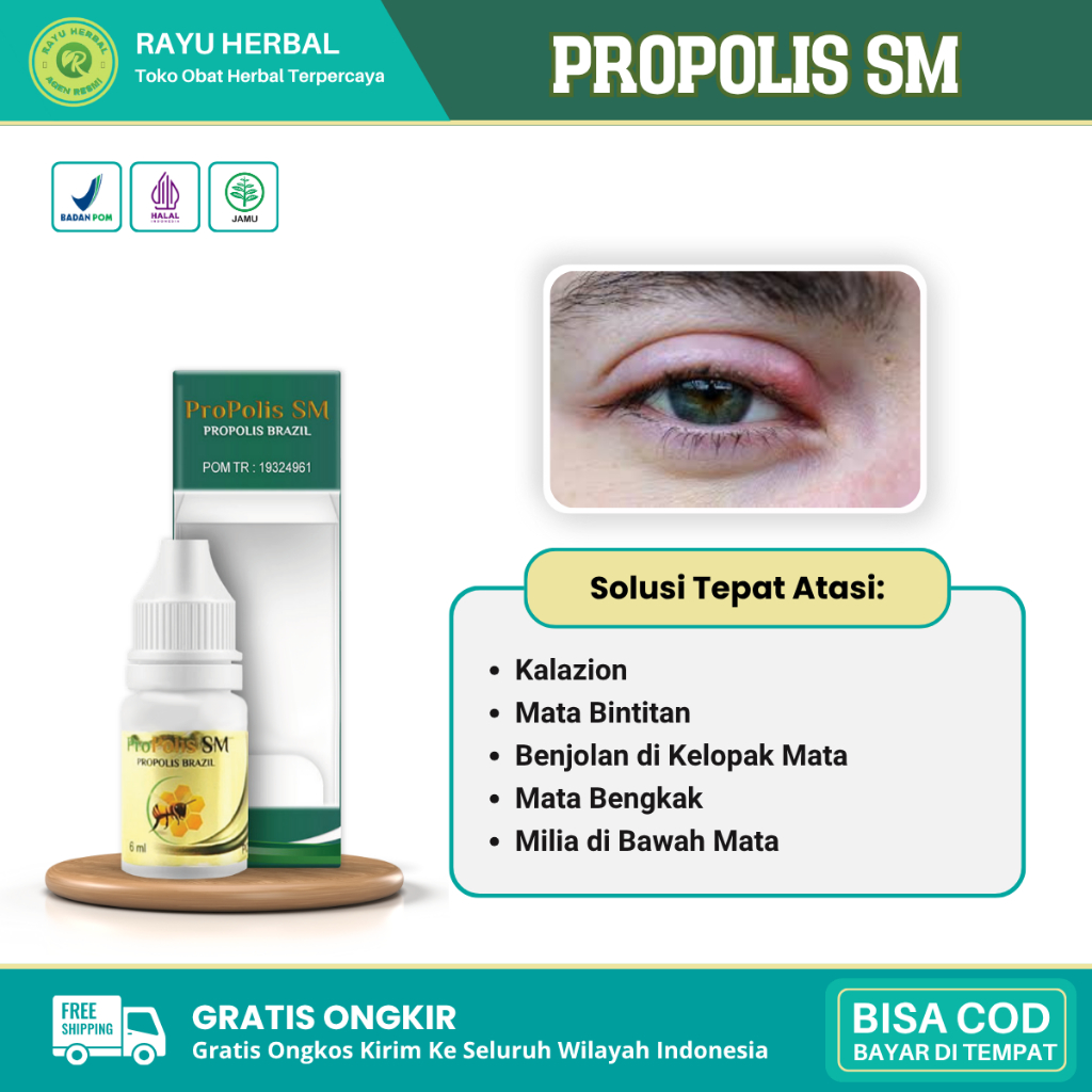 Jual Obat Oles Kalazion, Mata Kalazion Pada Anak Dan Dewasa, Bintitan ...