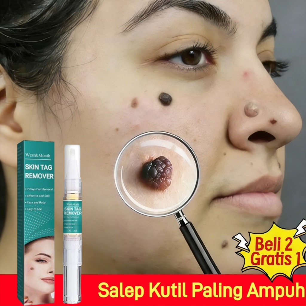 Jual Obat penghilang tahi lalat Ampuh Skin tag remover Penghilang tahi ...