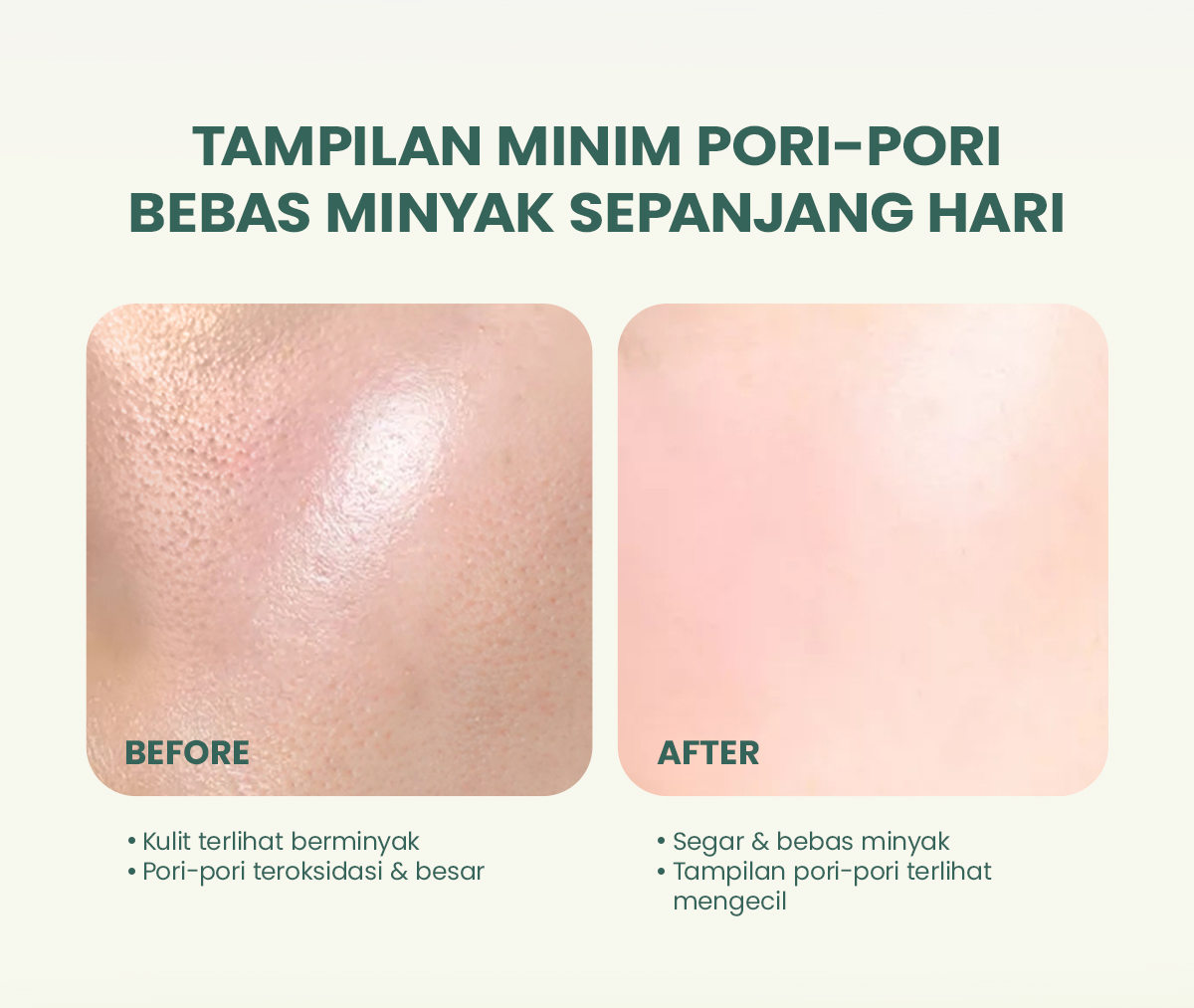 Jual [NEW] YOU AcnePlus 5X Acid Toner Toner Acne Kulit Berminyak ...