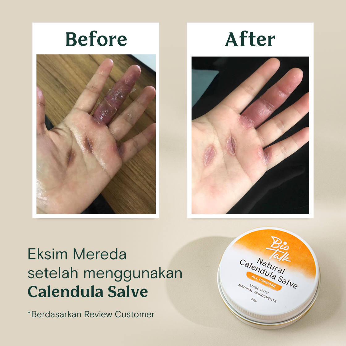 Jual [FLASH SALE] Biotalk Natural Calendula Salve | No Steroid ...