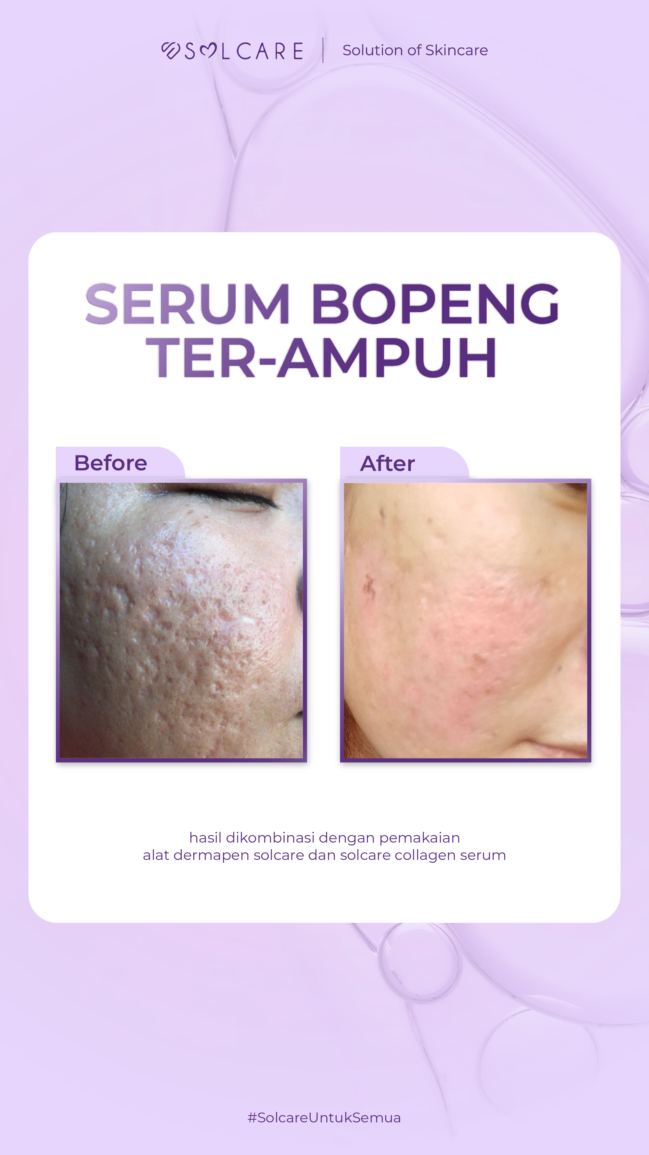 Jual BELI 1 FREE 9 Solcare Collagen Pore Minimizer Serum + DNA Salmon ...