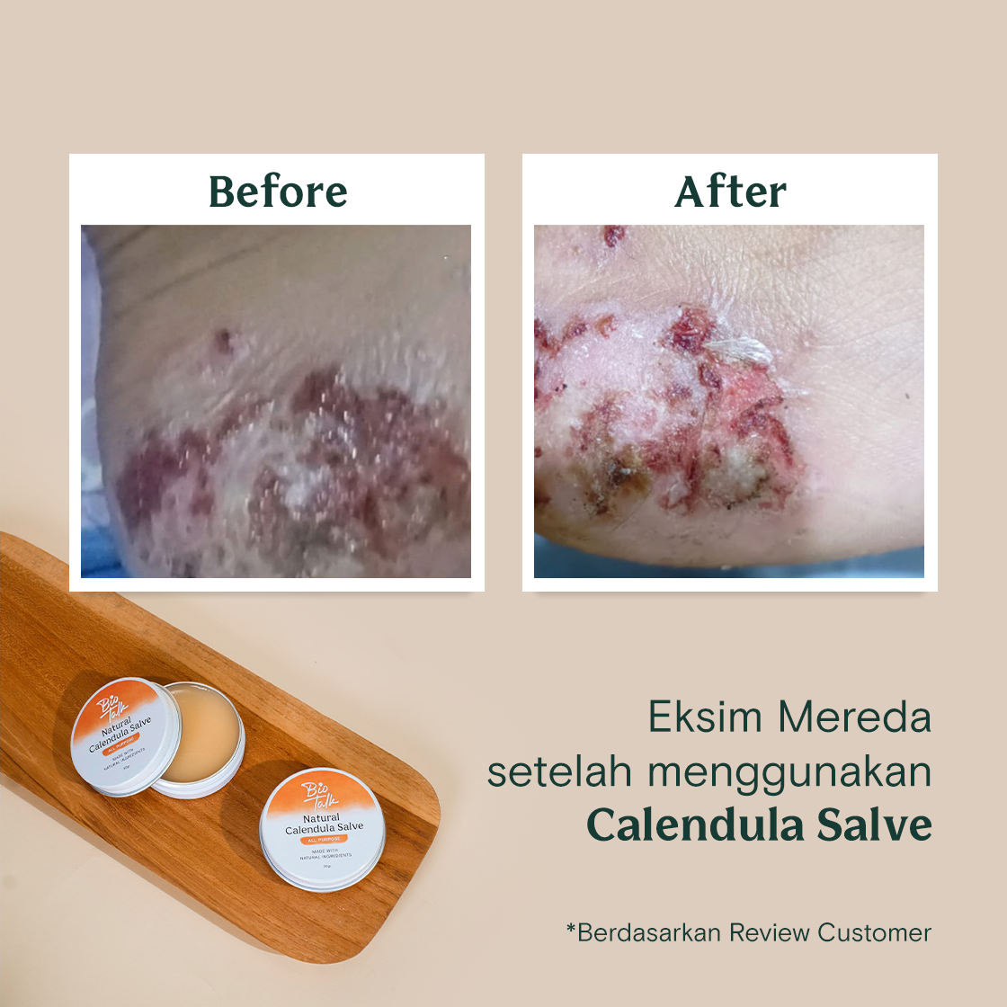 Jual Biotalk Natural Calendula Salve | No Steroid | Meredakan Kulit ...
