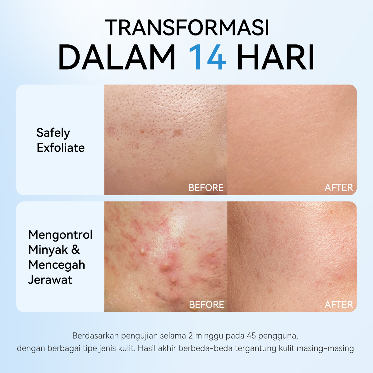 Jual [60 Pads] FOCALSKIN Acne Exfoliating Clear Pad Cica Pad / Kapas ...