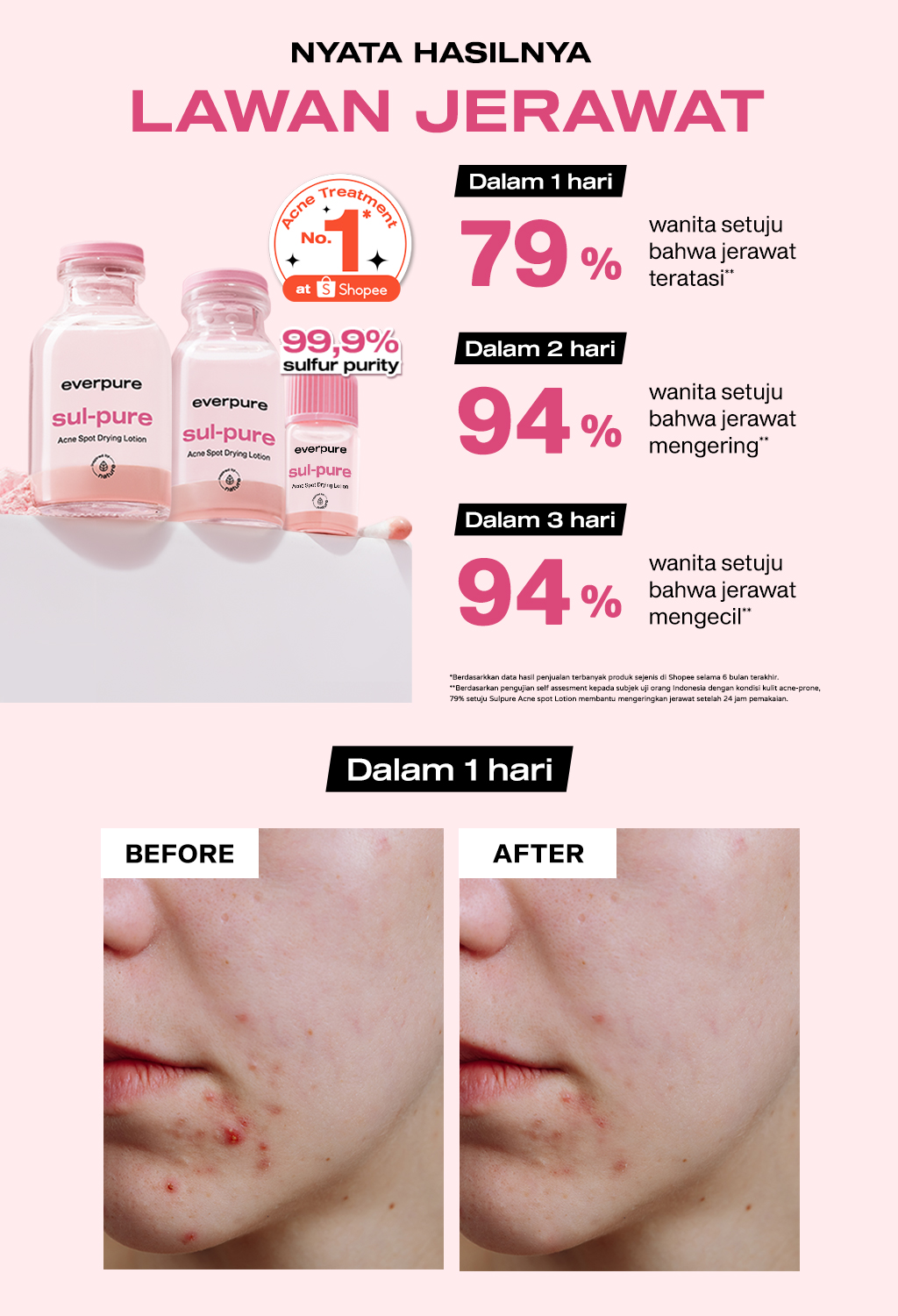 Jual EVERPURE Sul-pure Acne Spot Drying Lotion - Obat Totol ...