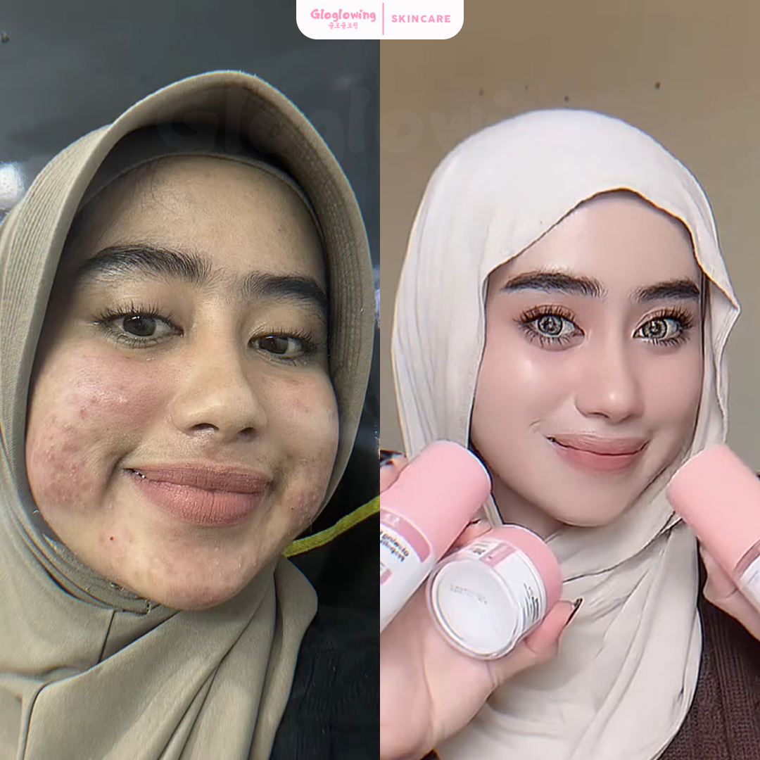 Jual DOSIS 1 ACNE - Paket Acne Spot Booster | Shopee Indonesia